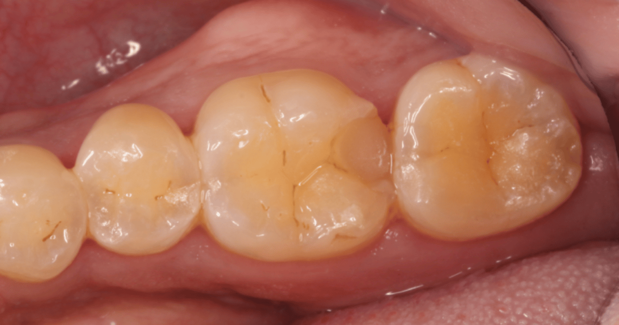 Clinical Guide: Class II Composite Replacement of Chipped Filling