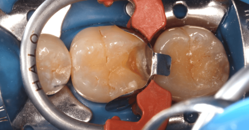 Clinical Guide: Class II Composite Replacement of Chipped Filling