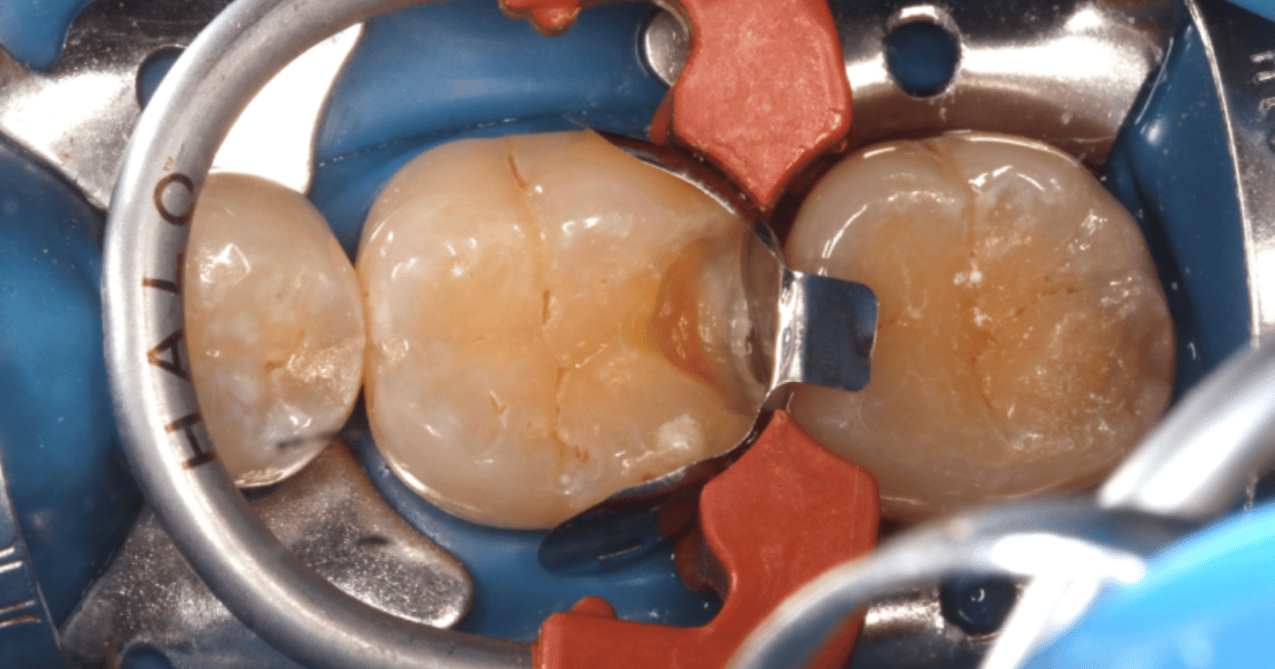Clinical Guide: Class II Composite Replacement of Chipped Filling