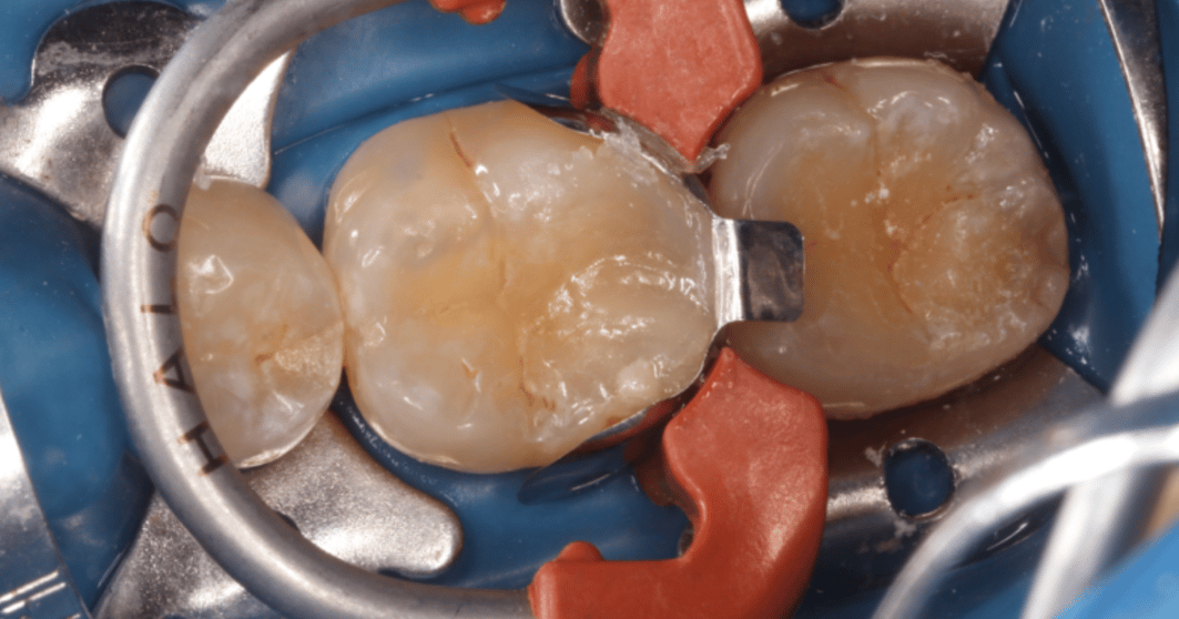Clinical Guide: Class II Composite Replacement of Chipped Filling