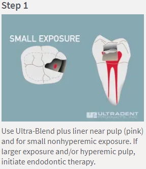 Bioactive Pulp Coverage with Ultra-Blend plus