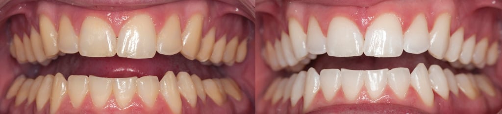 Talking to Your Patients About Light Vs No Light in Teeth Whitening