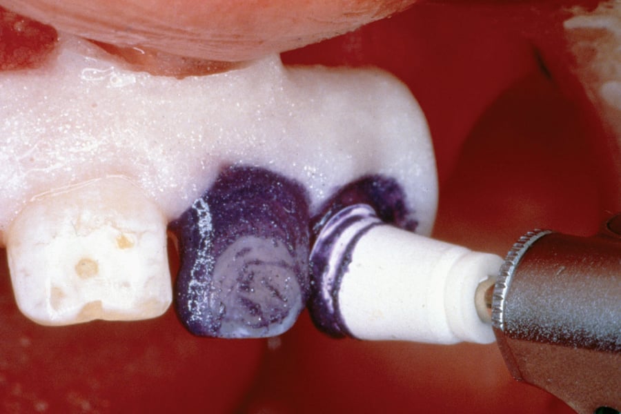 Enamel Microabrasion: Step-by-Step Technique