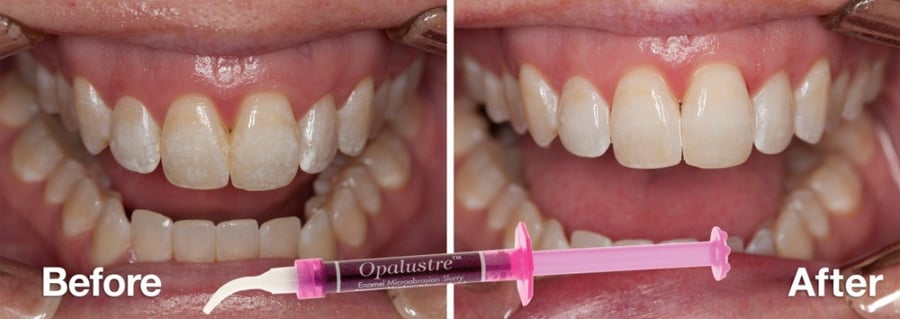 Enamel Microabrasion: Step-by-Step Technique