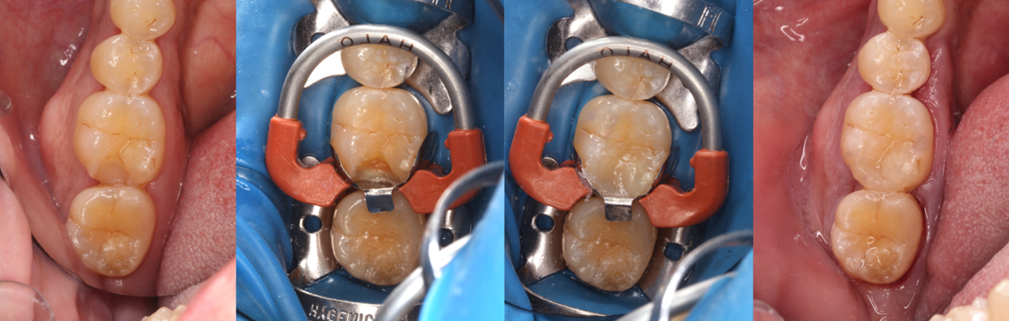Clinical Guide: Class II Composite Replacement of Chipped Filling